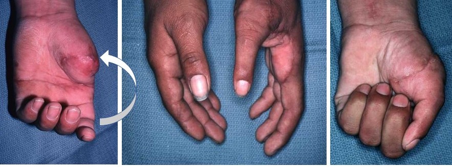 Thumb Reconstruction II: Borrowing